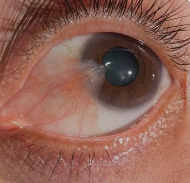 Pterygium (Eye Meat) - Düzey Göz